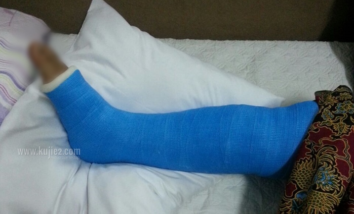 Fiberglass Balut Kaki Tulang Patah | Kujie2.com